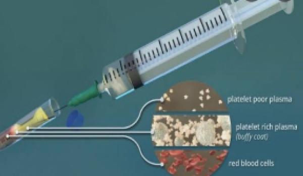 Efficiency of injecting Platelet-rich Plasma on cesarean wound sites