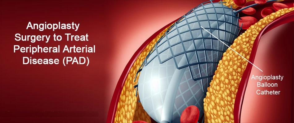 PERIPHERAL ARTERIAL DISEASE (PAD) | MS Ramaiah Memorial Hospital