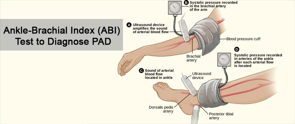 PERIPHERAL ARTERIAL DISEASE (PAD) | MS Ramaiah Memorial Hospital