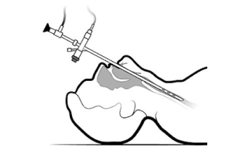 Rigid Bronchoscopy & Its Advantages | MS Ramaiah Memorial Hospital